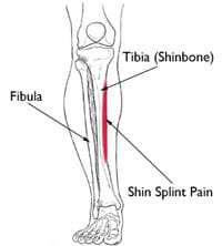 How To Treat Shin Splints At Home | PhysioPrescription