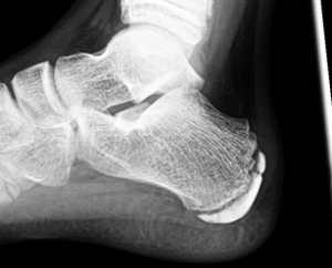 Sever's Disease: What, Why and How You Can Improve - PhysioPrescription